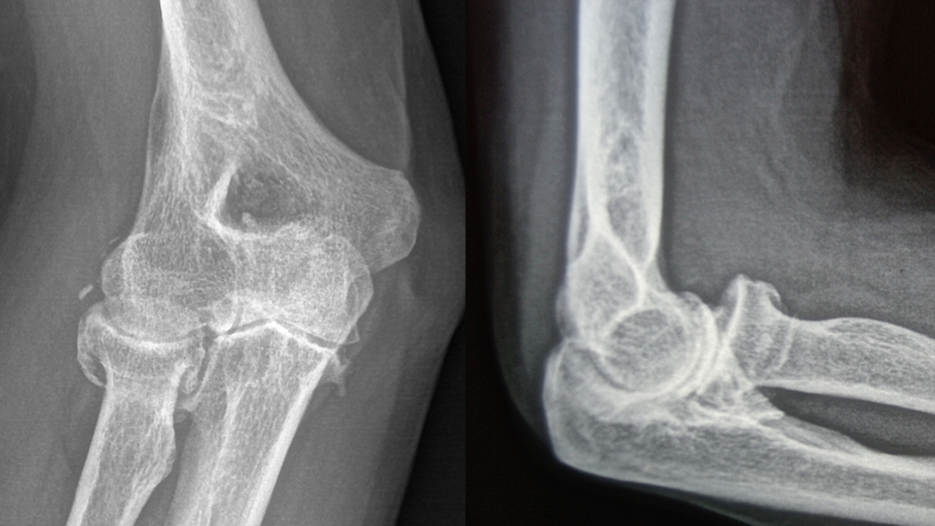 Arthrose du coude - Clinique Ostéo Articulaire des Cèdres - Grenoble