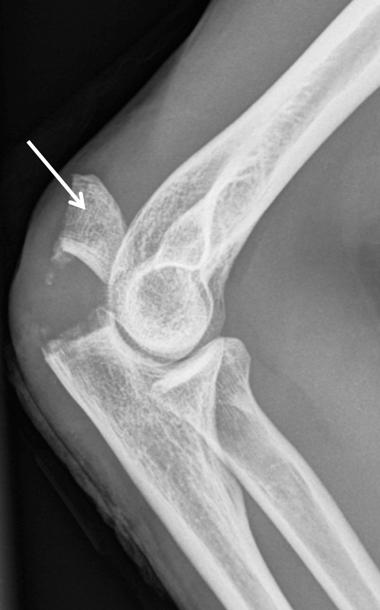 Fracture du coude - Clinique Ostéo Articulaire des Cèdres - Grenoble
