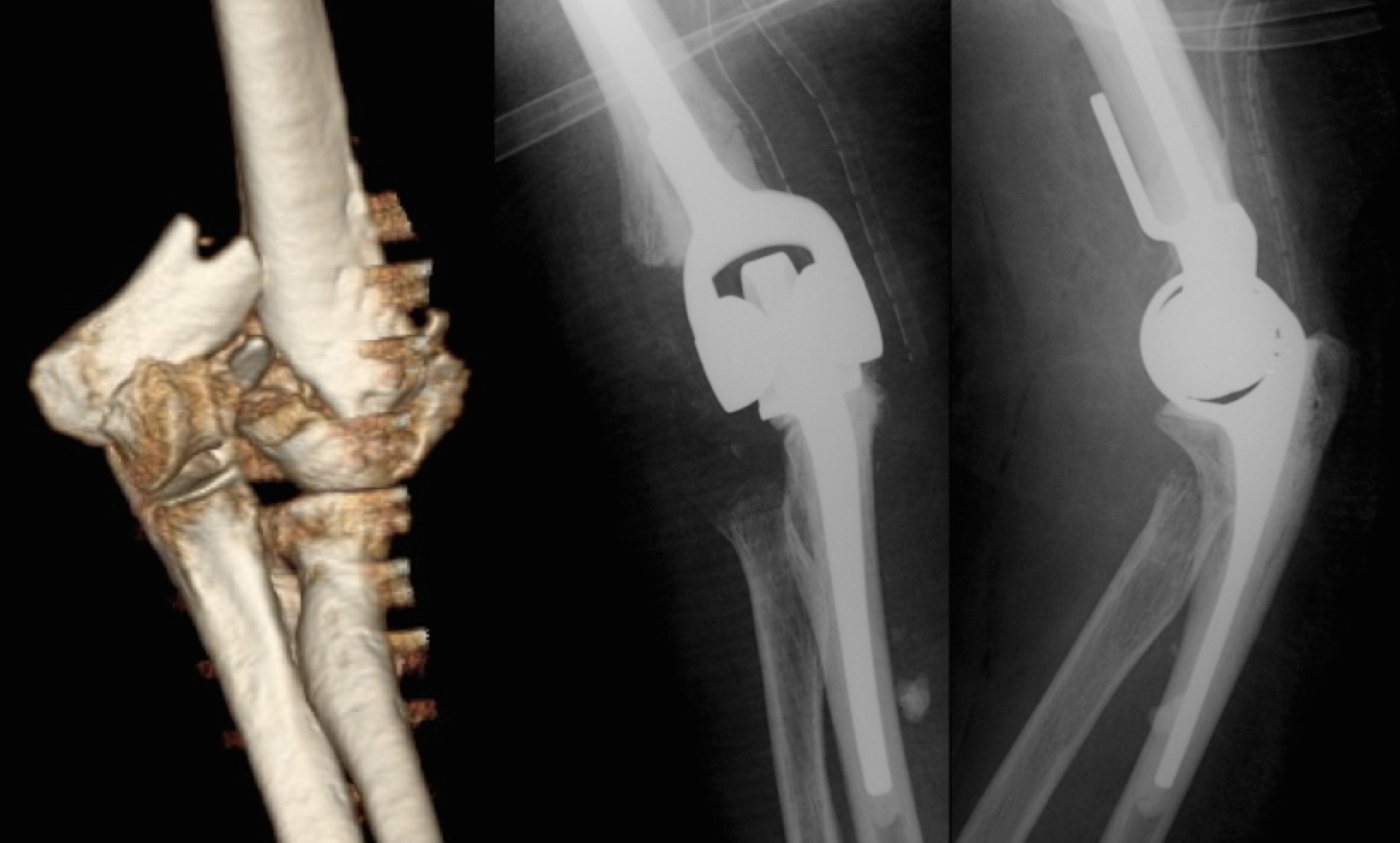 Fracture du coude - Clinique Ostéo Articulaire des Cèdres - Grenoble