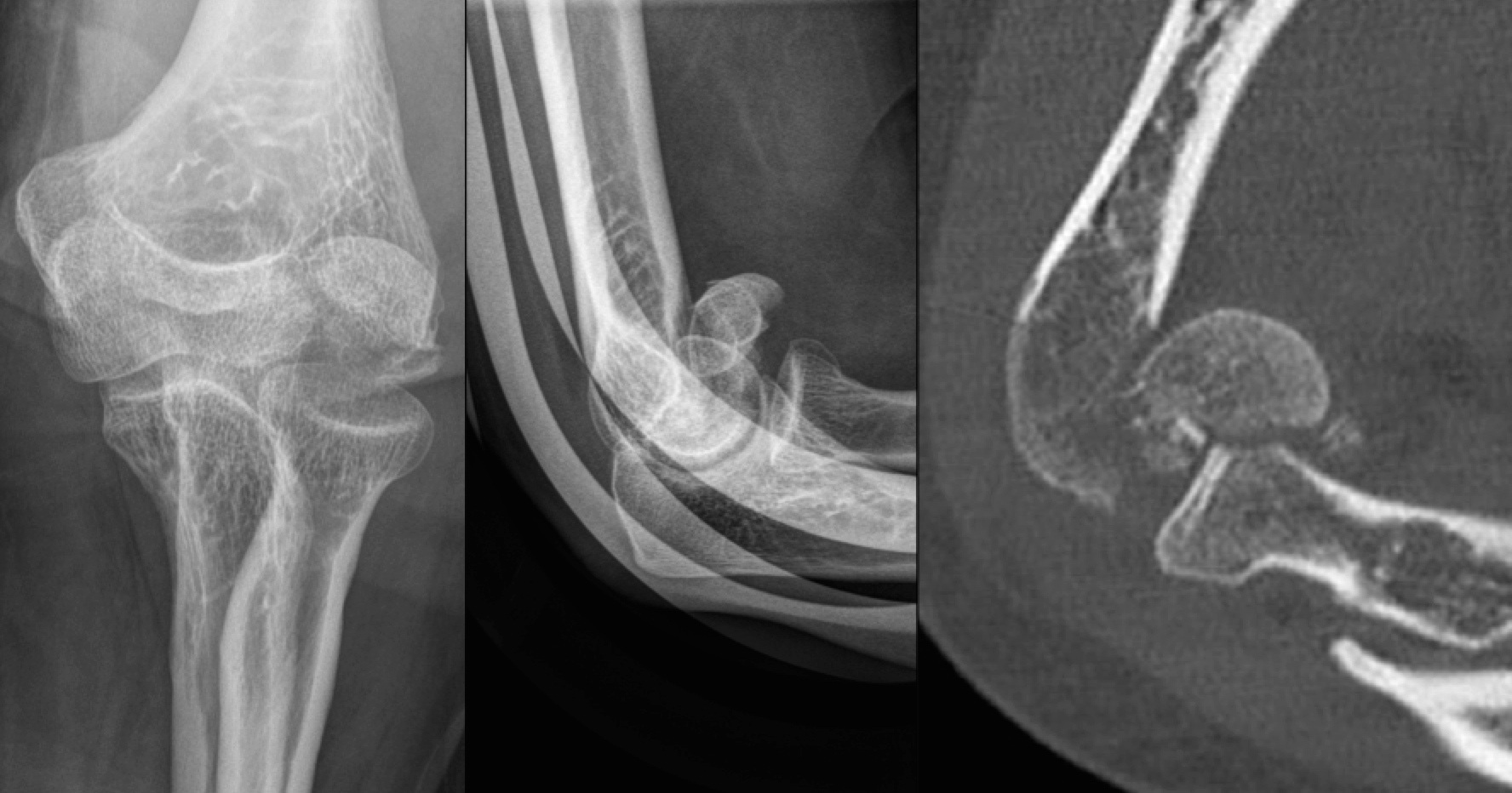Fracture du coude - Clinique Ostéo Articulaire des Cèdres - Grenoble