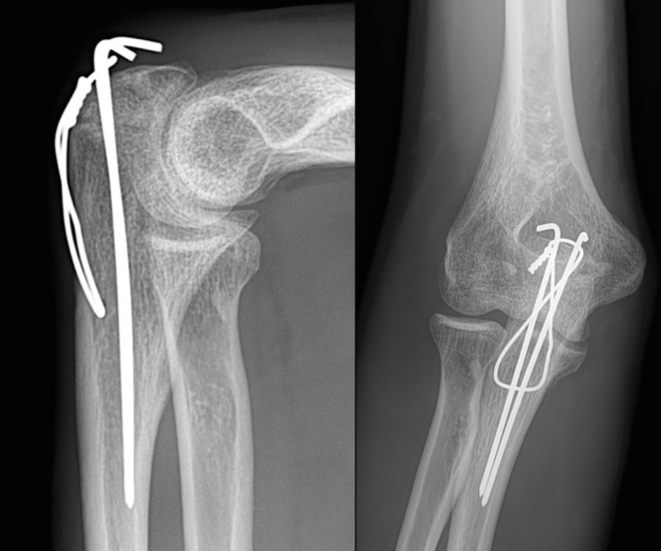 Fracture du coude - Clinique Ostéo Articulaire des Cèdres - Grenoble