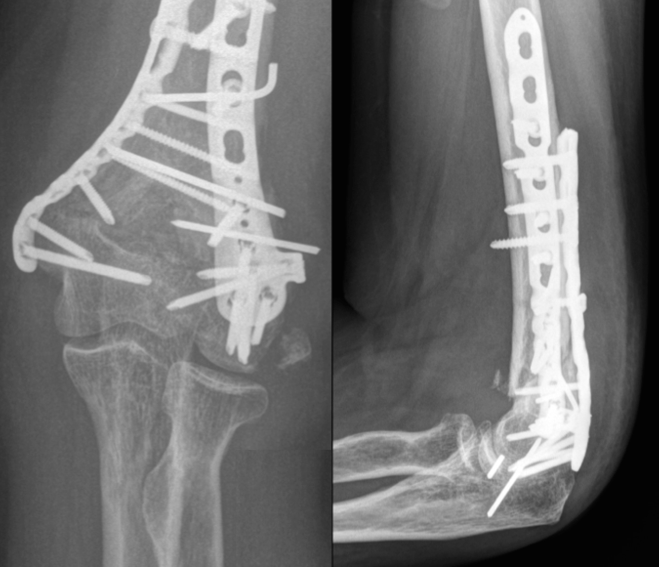 Fracture du coude - Clinique Ostéo Articulaire des Cèdres - Grenoble