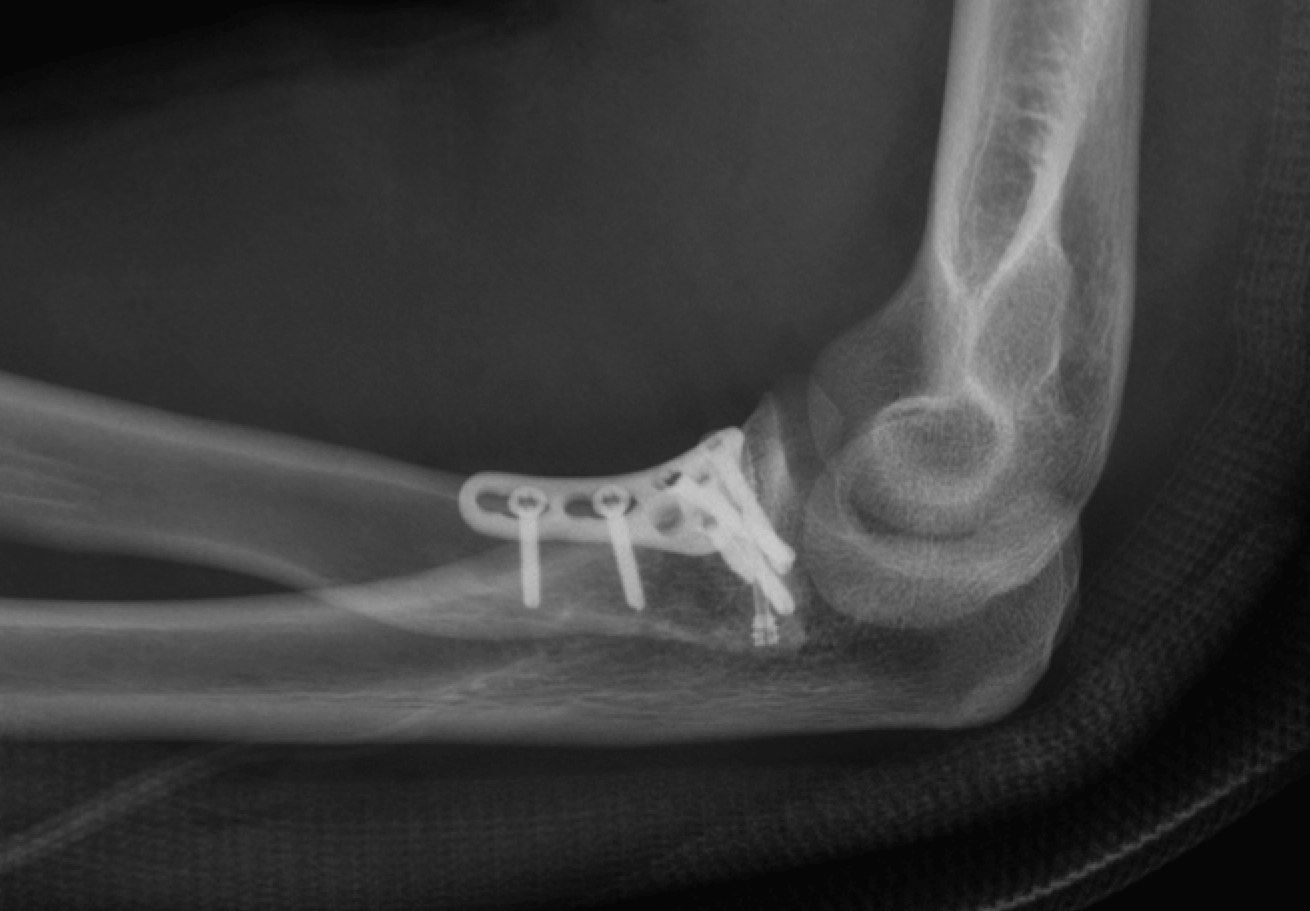 Fracture du coude - Clinique Ostéo Articulaire des Cèdres - Grenoble