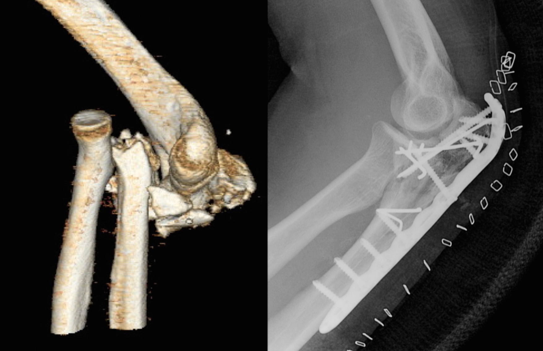 Fracture du coude - Clinique Ostéo Articulaire des Cèdres - Grenoble