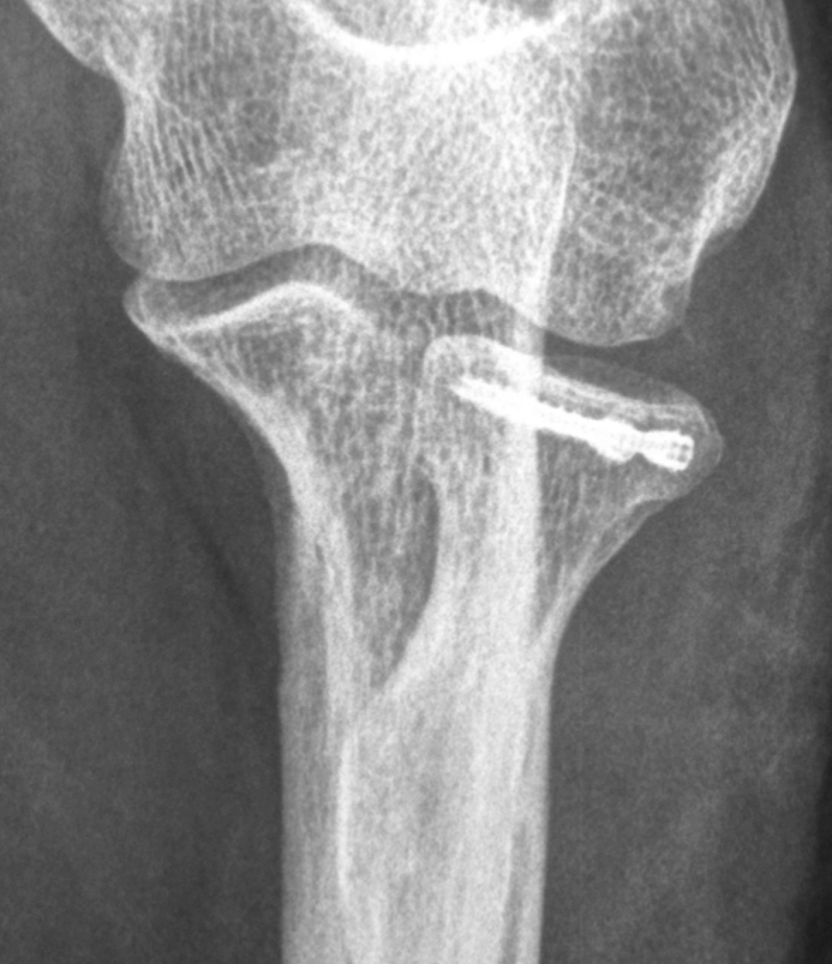 Fracture du coude - Clinique Ostéo Articulaire des Cèdres - Grenoble