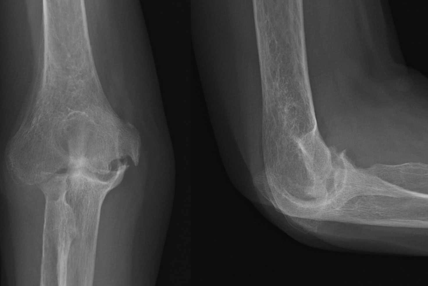 Coude rhumatoïde - Clinique Ostéo Articulaire des Cèdres - Grenoble