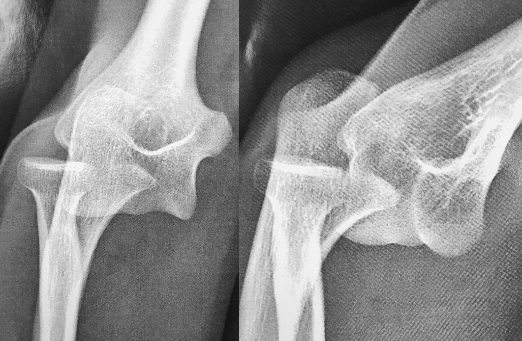 Instabilité/luxation du coude - Clinique Ostéo Articulaire des Cèdres ...