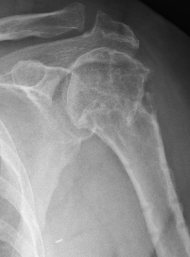 Fractures de l'épaule - Clinique Ostéo Articulaire des Cèdres - Grenoble