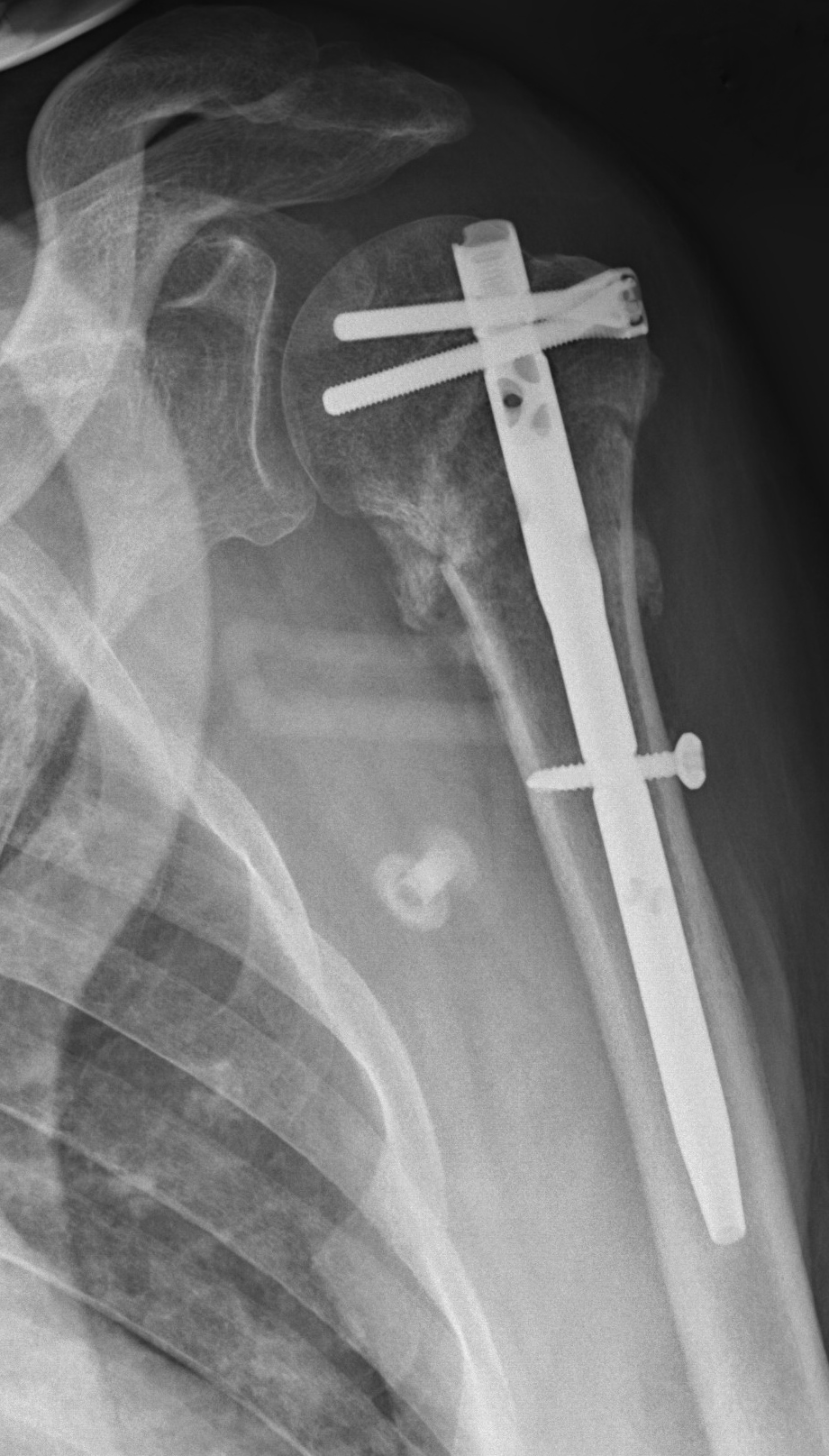 Fractures de l'épaule - Clinique Ostéo Articulaire des Cèdres - Grenoble