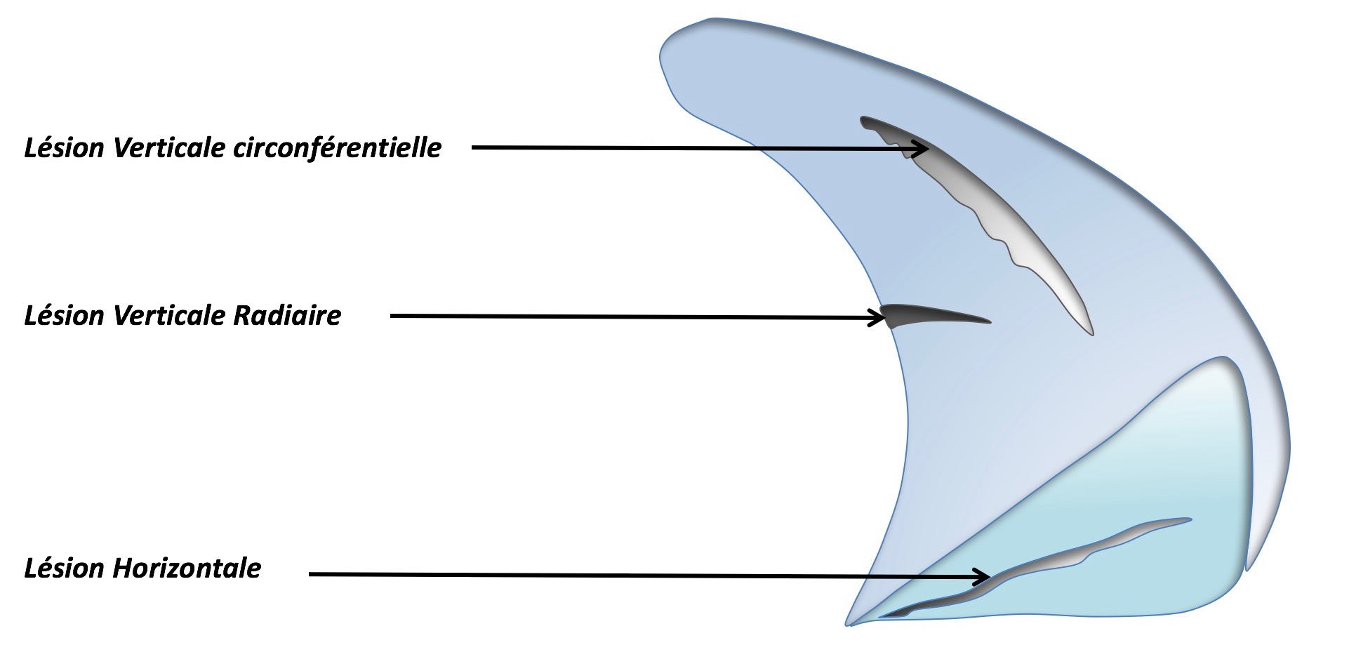 Lésions méniscales - Clinique Ostéo Articulaire des Cèdres - Grenoble