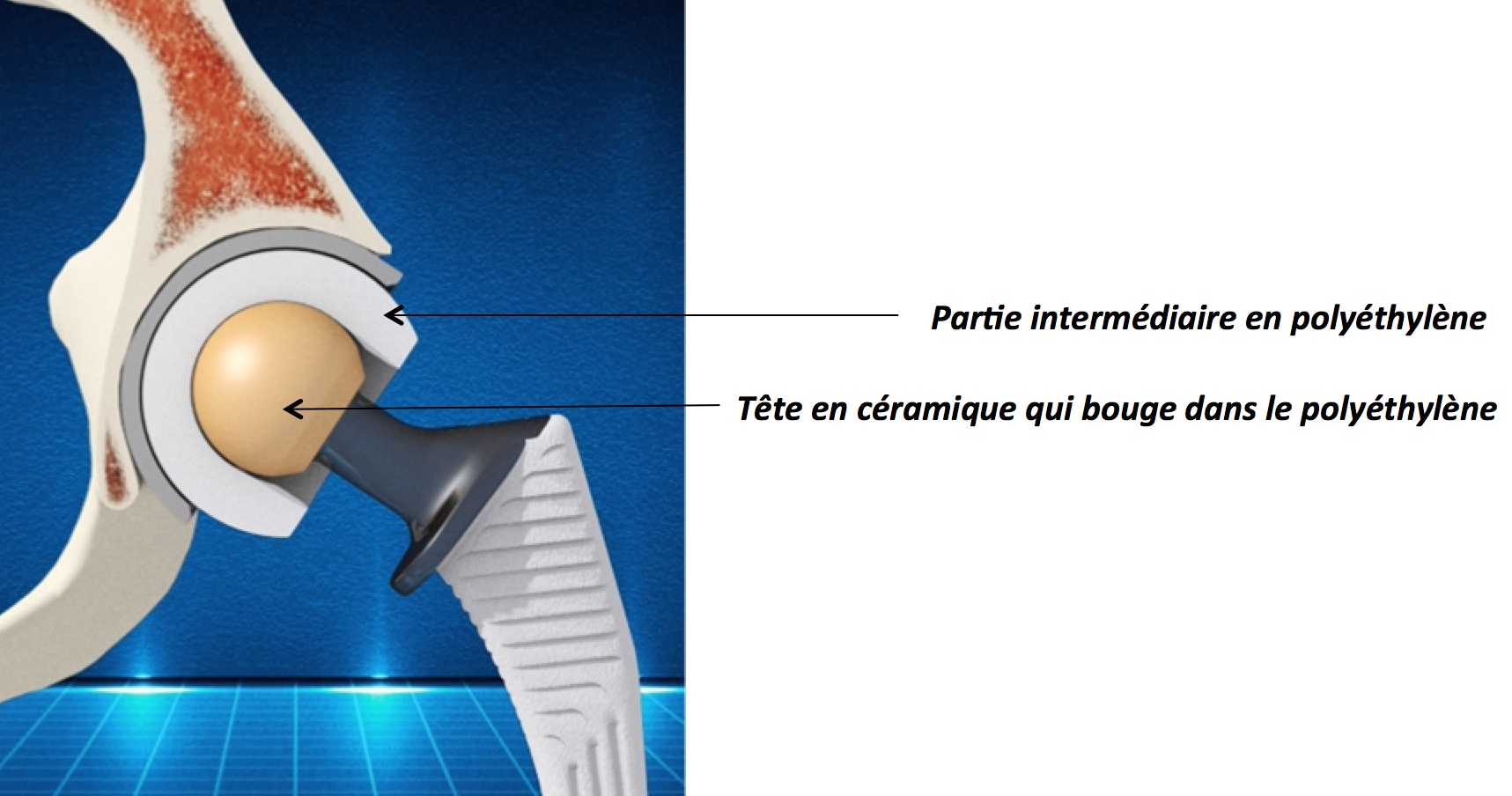 Prothèse totale de hanche - Clinique Ostéo Articulaire des Cèdres ...