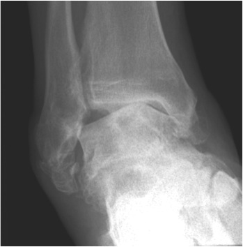 Arthrose de la cheville - Clinique Ostéo Articulaire des Cèdres - Grenoble