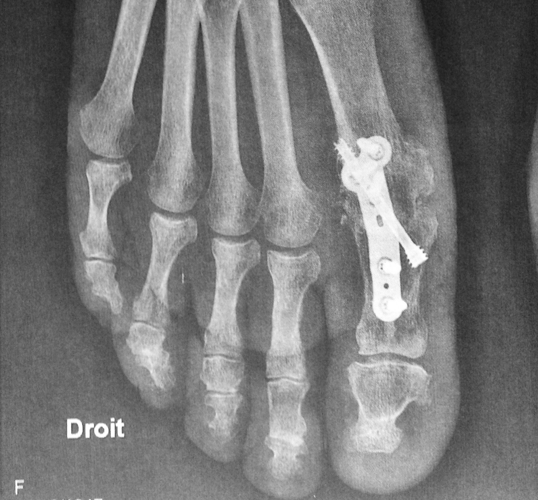 Hallux rigidus - Clinique Ostéo Articulaire des Cèdres - Grenoble