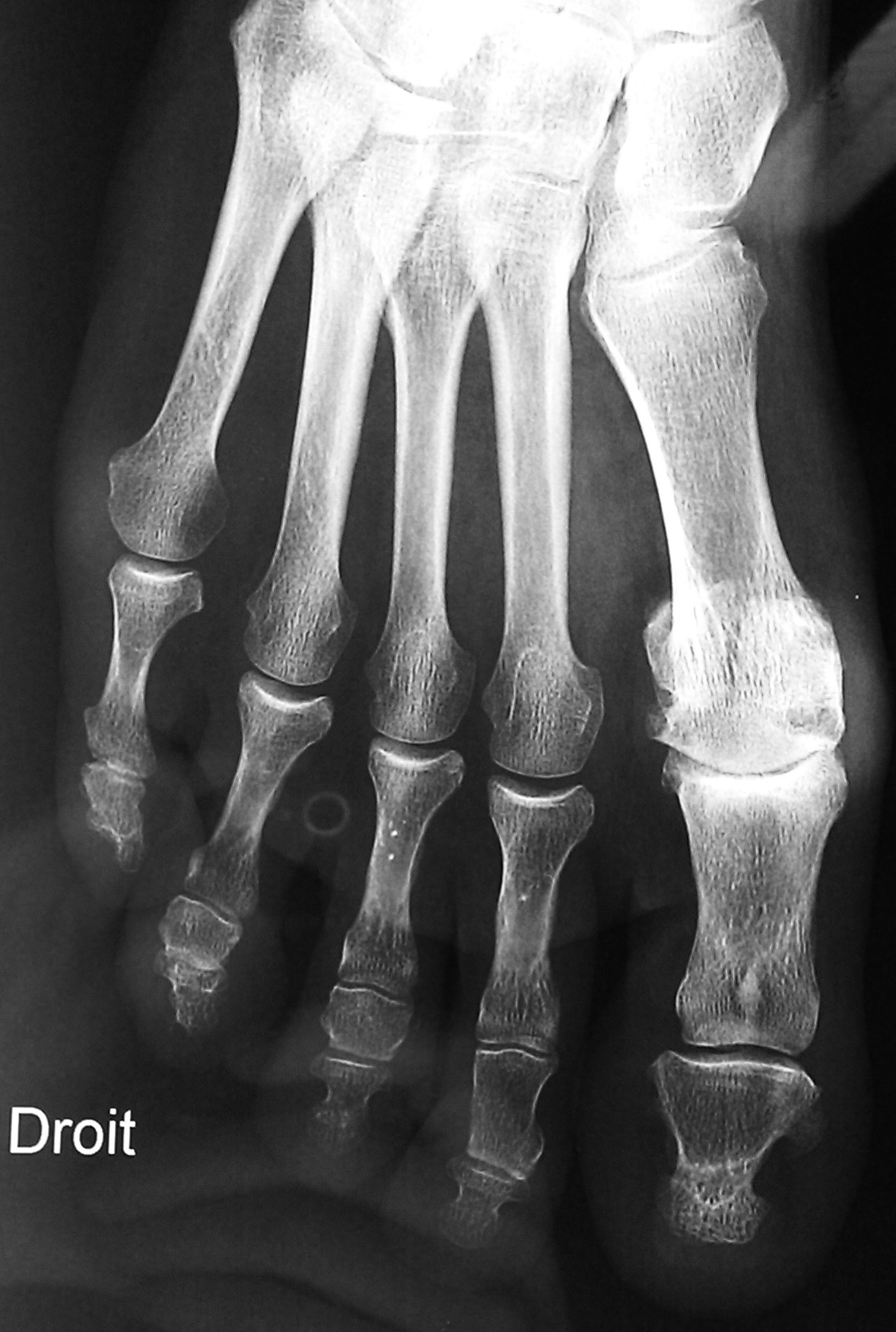 Hallux rigidus - Clinique Ostéo Articulaire des Cèdres - Grenoble
