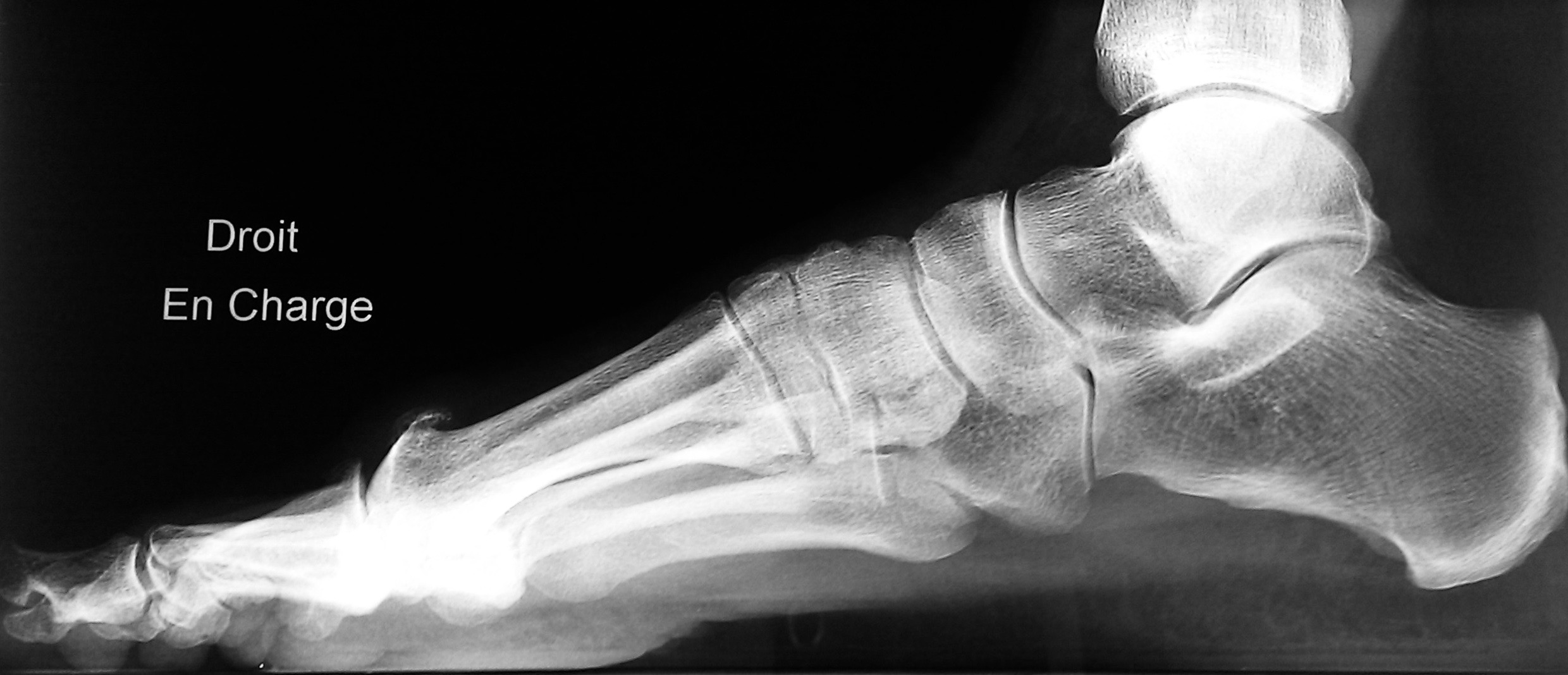 Hallux rigidus - Clinique Ostéo Articulaire des Cèdres - Grenoble