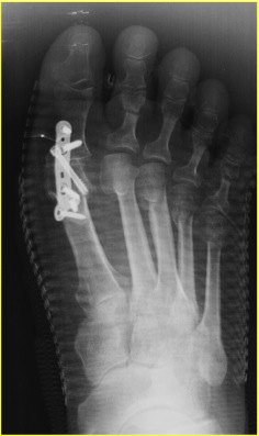 Hallux varus - Clinique Ostéo Articulaire des Cèdres - Grenoble