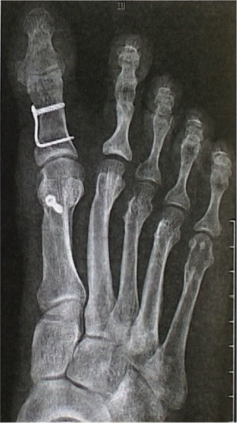 Hallux varus - Clinique Ostéo Articulaire des Cèdres - Grenoble