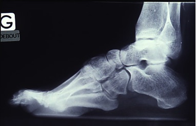 Pied creux varus - Clinique Ostéo Articulaire des Cèdres - Grenoble