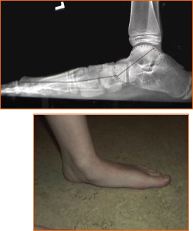 Pied plat - Clinique Ostéo Articulaire des Cèdres - Grenoble