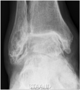 Arthrose de la cheville - Clinique Ostéo Articulaire des Cèdres - Grenoble