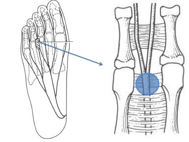 Névrome de Morton - Clinique Ostéo Articulaire des Cèdres - Grenoble
