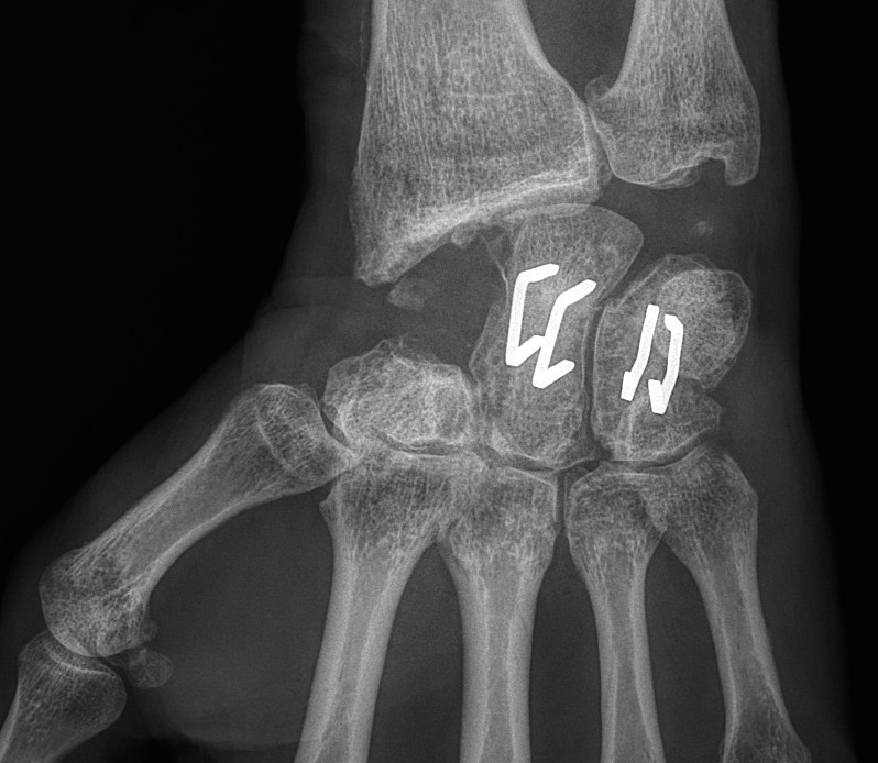 Arthrose du poignet - Clinique Ostéo Articulaire des Cèdres - Grenoble