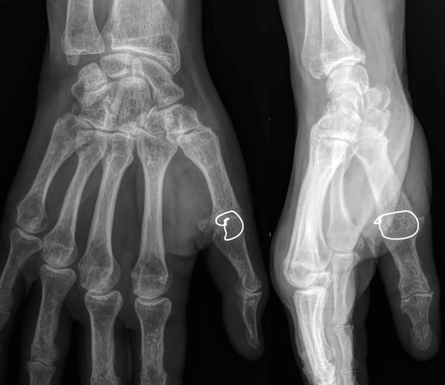 Rhizarthrose / Arthrose du pouce - Clinique Ostéo Articulaire des ...