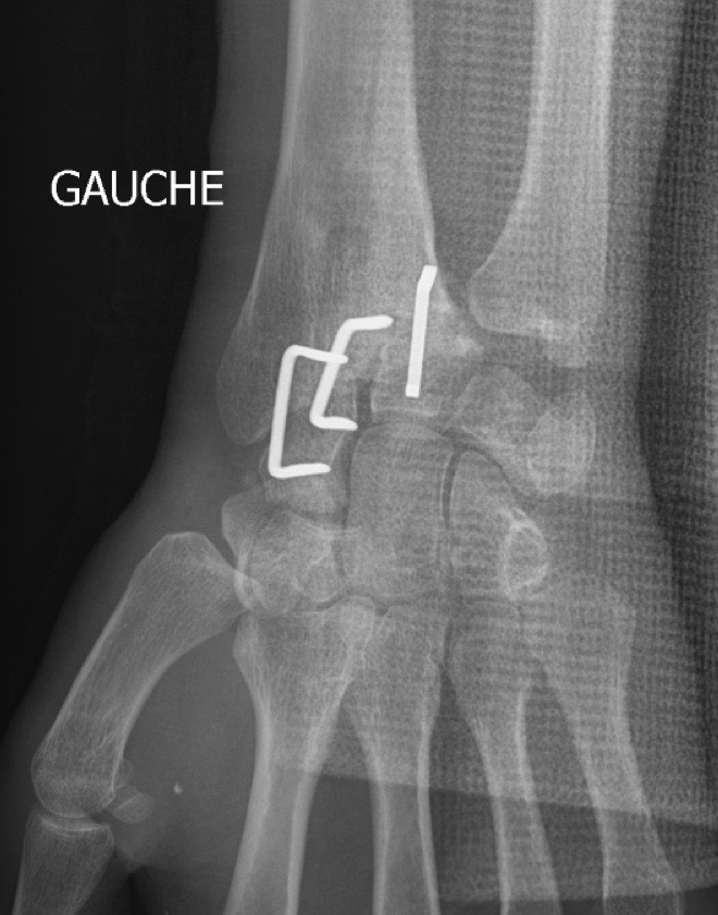 Arthrose du poignet - Clinique Ostéo Articulaire des Cèdres - Grenoble