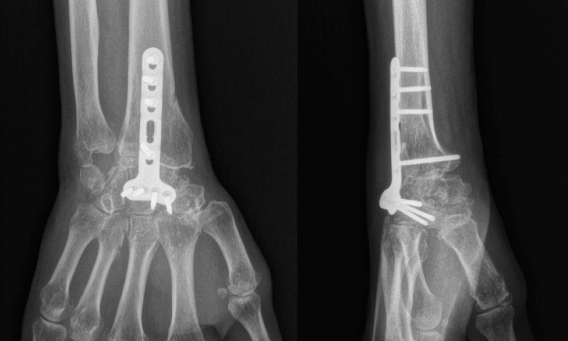 Arthrose du poignet - Clinique Ostéo Articulaire des Cèdres - Grenoble