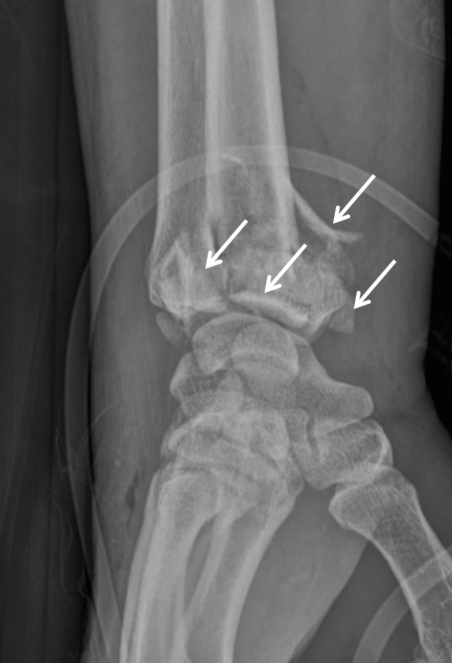 Fracture du poignet - Clinique Ostéo Articulaire des Cèdres - Grenoble