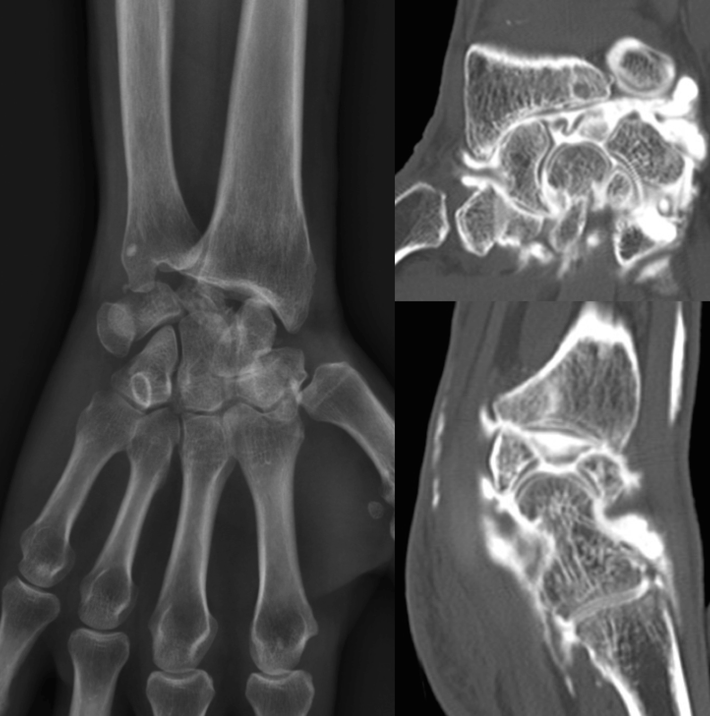 Arthrose du poignet - Clinique Ostéo Articulaire des Cèdres - Grenoble