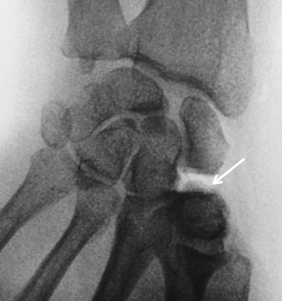 Rhizarthrose / Arthrose du pouce - Clinique Ostéo Articulaire des ...