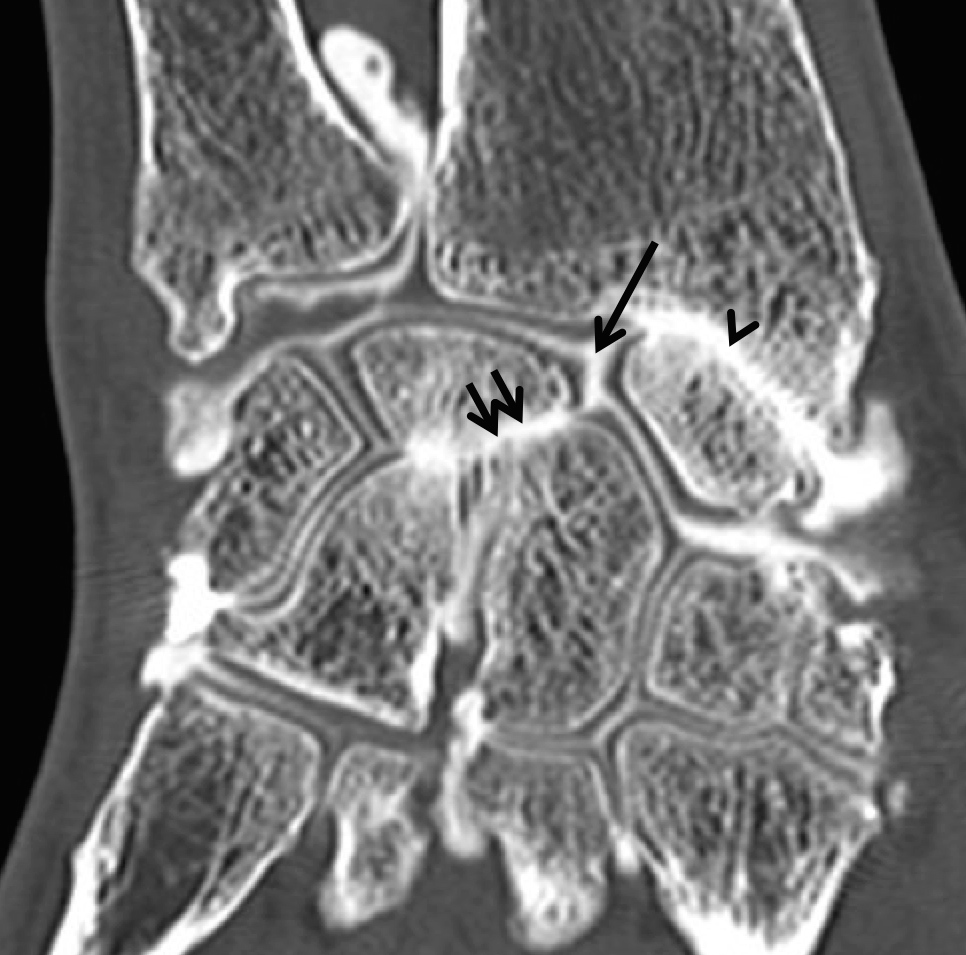 Arthrose du poignet - Clinique Ostéo Articulaire des Cèdres - Grenoble