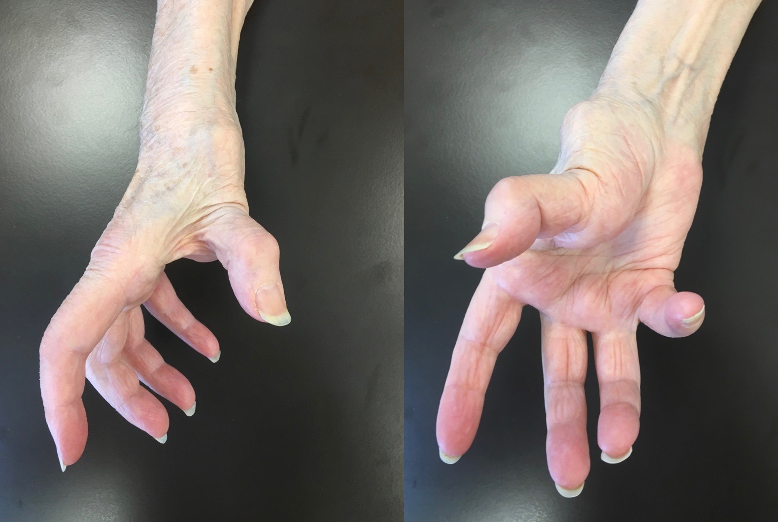 Rhizarthrose / Arthrose du pouce - Clinique Ostéo Articulaire des ...