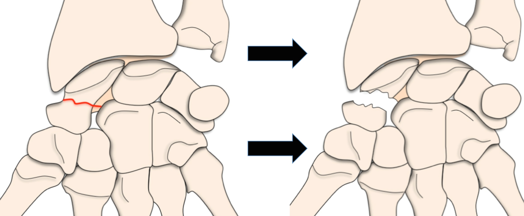 Fractures et pseudarthroses du scaphoïde - Clinique Ostéo Articulaire ...