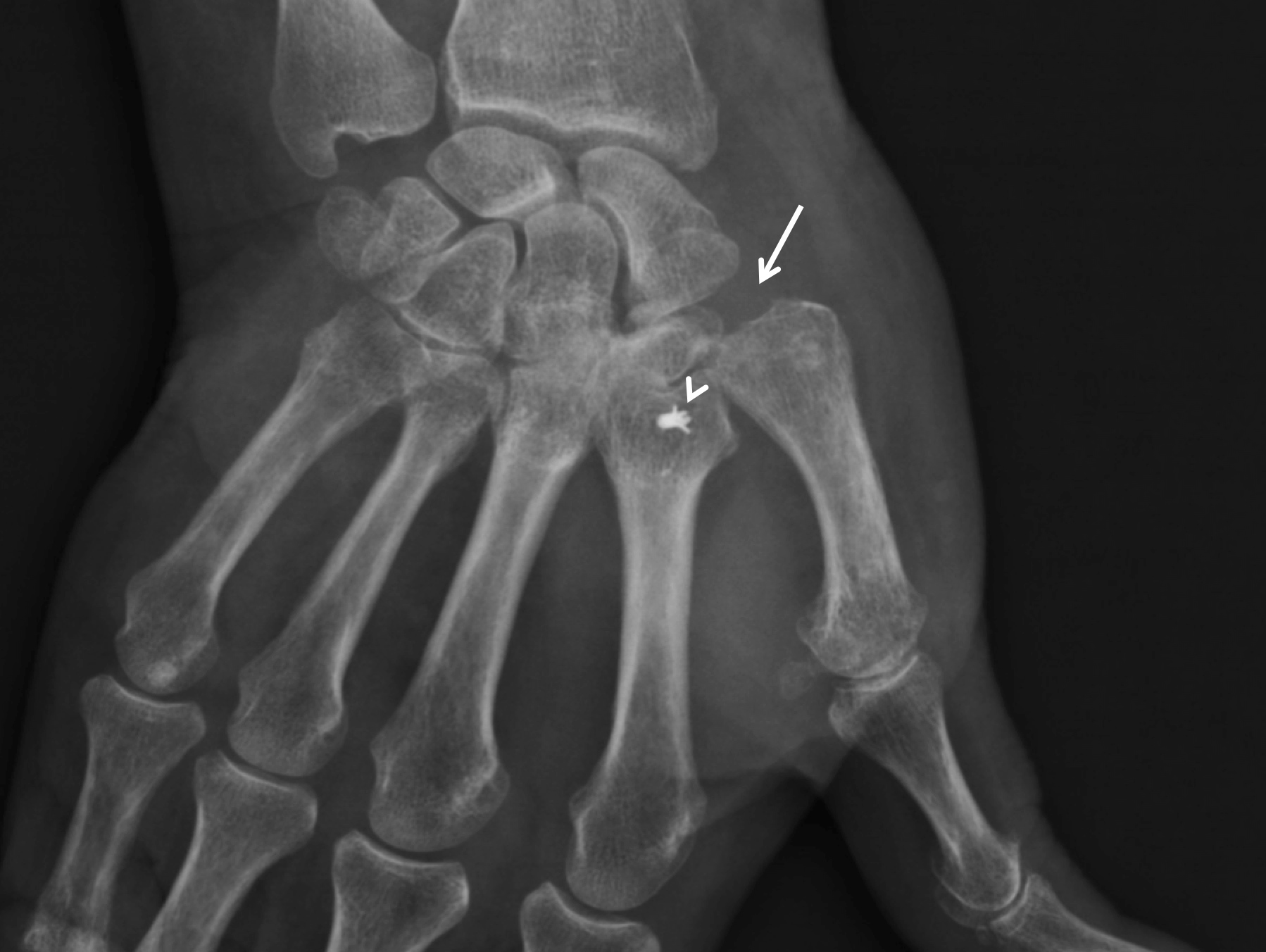 Rhizarthrose / Arthrose du pouce - Clinique Ostéo Articulaire des ...